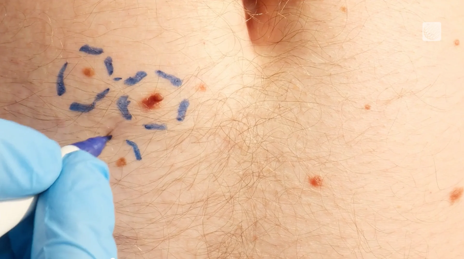Early detection matters: Mole Mobile revolutionizes skin cancer ...