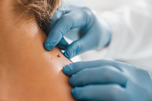 How to detect melanoma using the ABCDE method - The Weather Network
